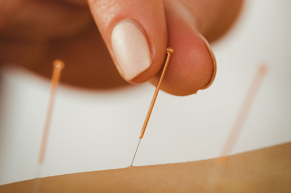 Acupuncture Infertility Treatments L Fertility Acupuncture Therapy L Scrc